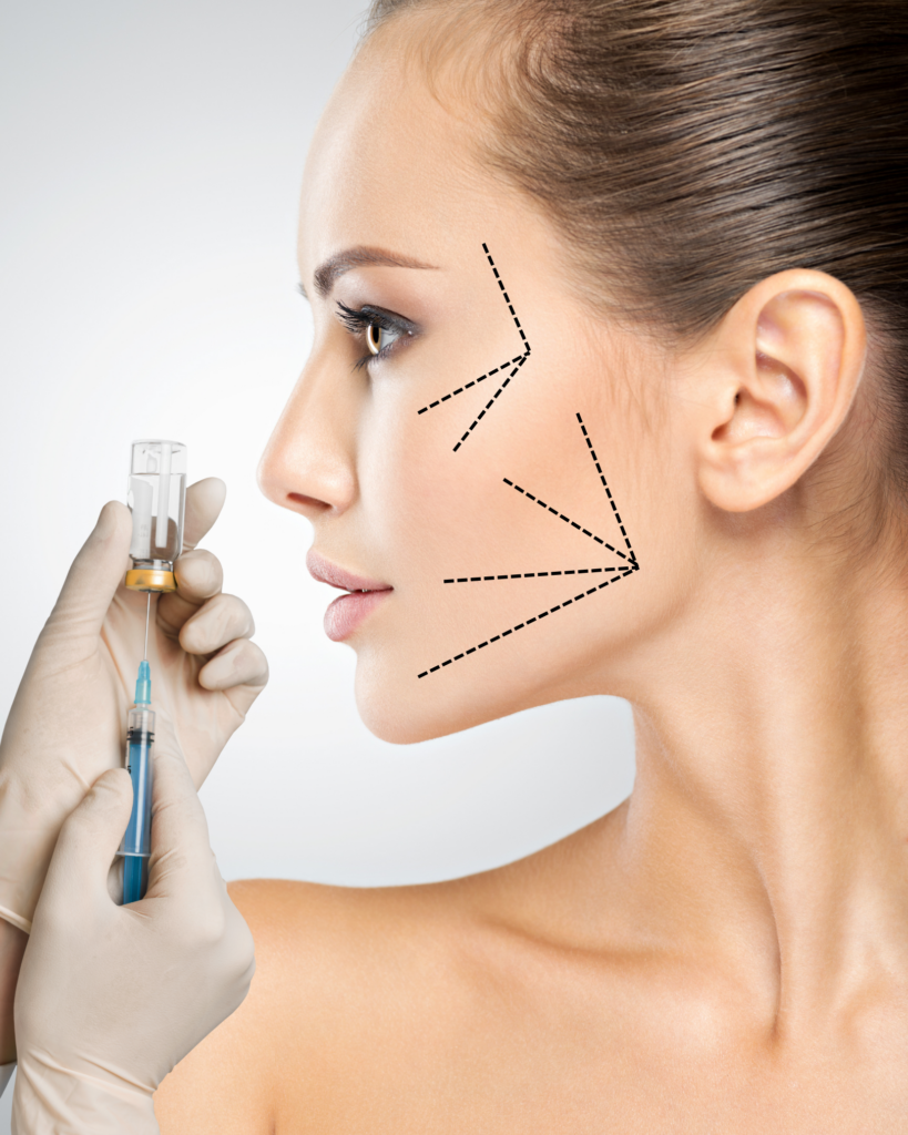 Sculptra – Dra. Francine Bravo
